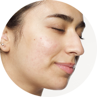 Nodular Acne Treatment | ABSORICA LD™ (isotretinoin)
