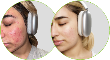 What is ABSORICA LD? | ABSORICA LD™ (isotretinoin)