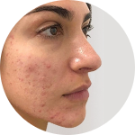 Nodular Acne Treatment | ABSORICA LD™ (isotretinoin)
