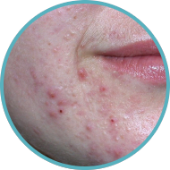 About Severe Acne