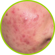 About Severe Acne