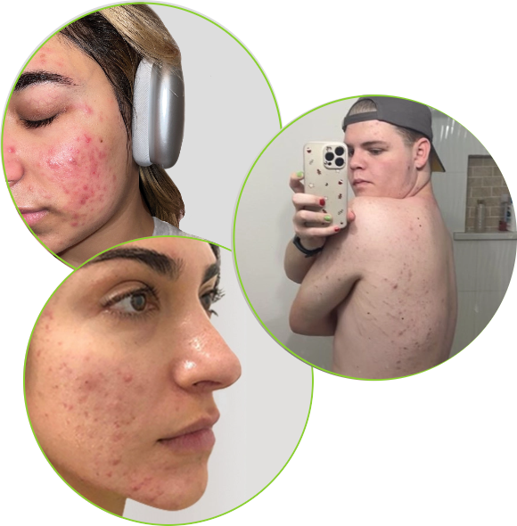 About Severe Acne